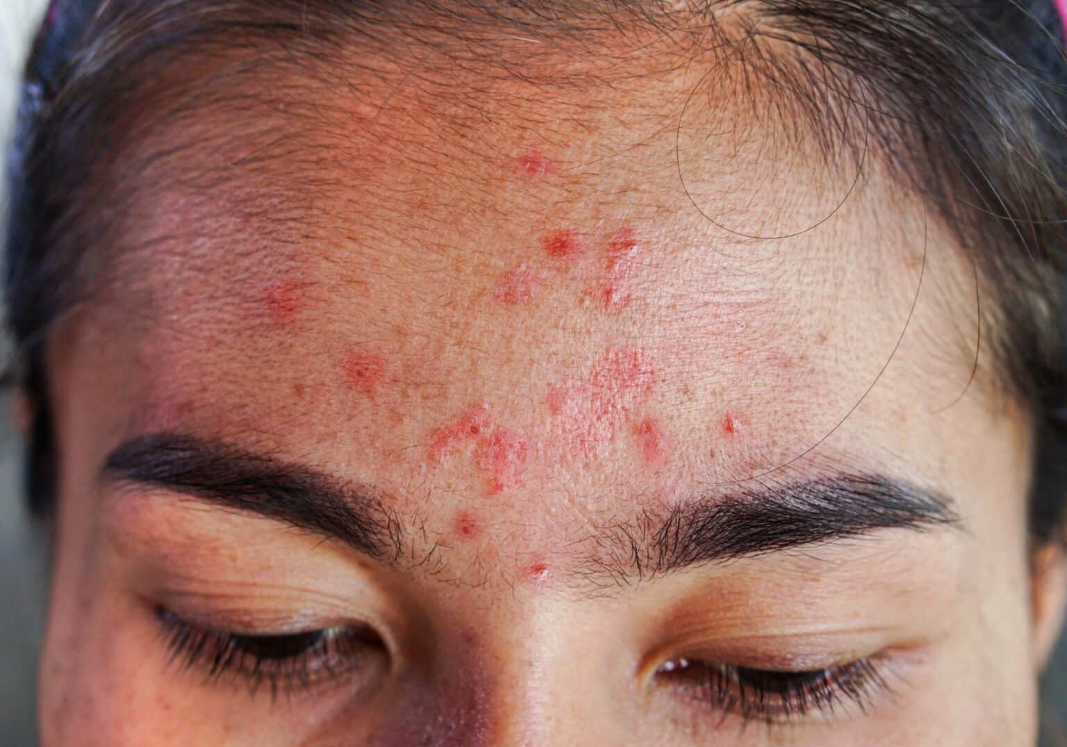 Steroid Addiction: Signs, Symptoms, Effects and Treatment